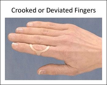 Use an Oval-8 to treat crooked or deviated fingers