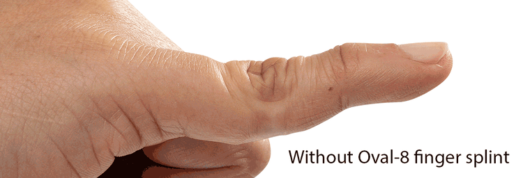 The Original Oval-8 Finger Splints | 3-Point Products