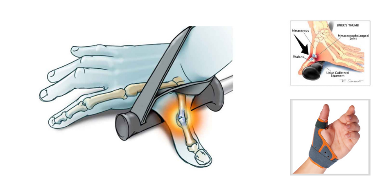 Treating Trigger Thumb with an Oval-8 Finger Splint - Updated 2023 Treating Trigger Thumb with an Oval-8 Finger Splint - Updated 2023
