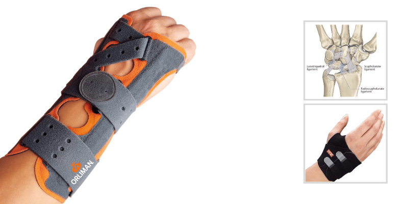 Splint Immobilization For Treatment of a Scapholunate Ligament Injury