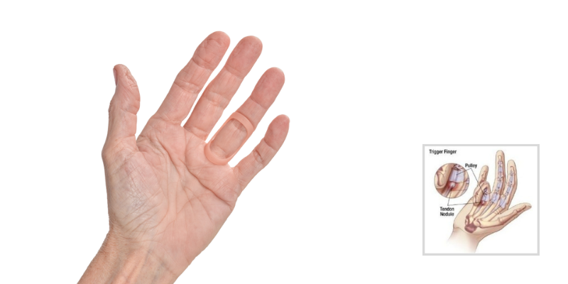 Treating Trigger Thumb with an Oval-8 Finger Splint - Updated 2023