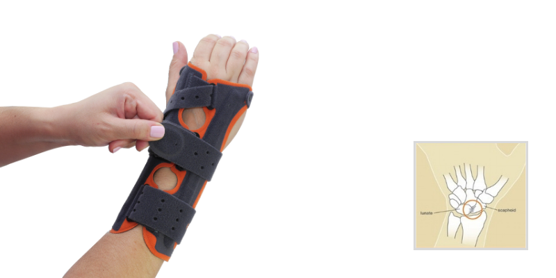 Splint Immobilization For Treatment of a Scapholunate Ligament Injury