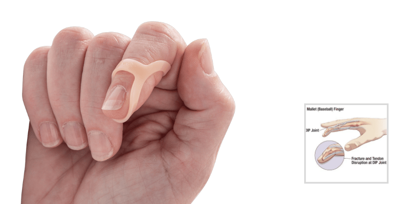 Mallet Finger - A Clinical Protocol