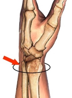 Orthotic Management Of The Distal Radioulnar Joint (DRUJ)