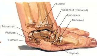 Wrist Pain after a Fall on an Outstretched Hand (FOOSH)