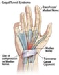 Carpal Tunnel Syndrome: What Do the Lumbricals Have to Do With It?
