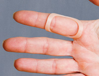 Using a Splint for Treatment of Trigger Finger