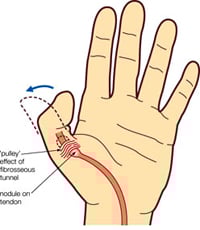 Treating Trigger Thumb with an Oval-8 Finger Splint