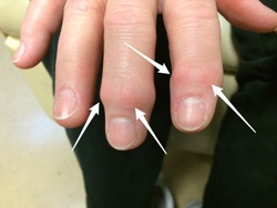 Osteoarthritis Finger Nodules