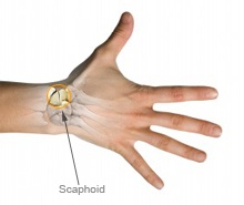 Scaphoid Fractures - Treatment and Rehabilitation