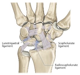 Ulnar-Sided Wrist Pain: Lunotriquetral Dissociation